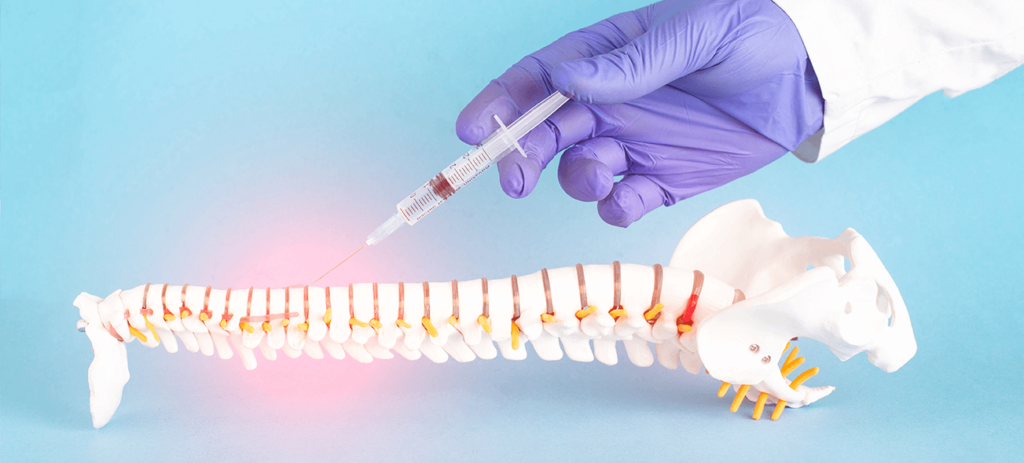 Selective Nerve Blocks | Synergy Spine and Pain Center